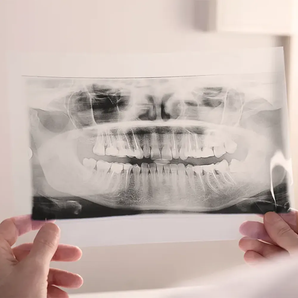 Wisdom Teeth - Leeming Dental
